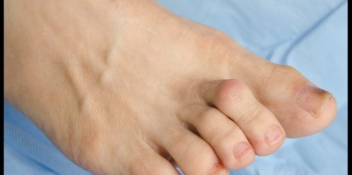 Hammertoe Treatment - Podiatrist Near Me Pittsburgh Foot Doctor ...