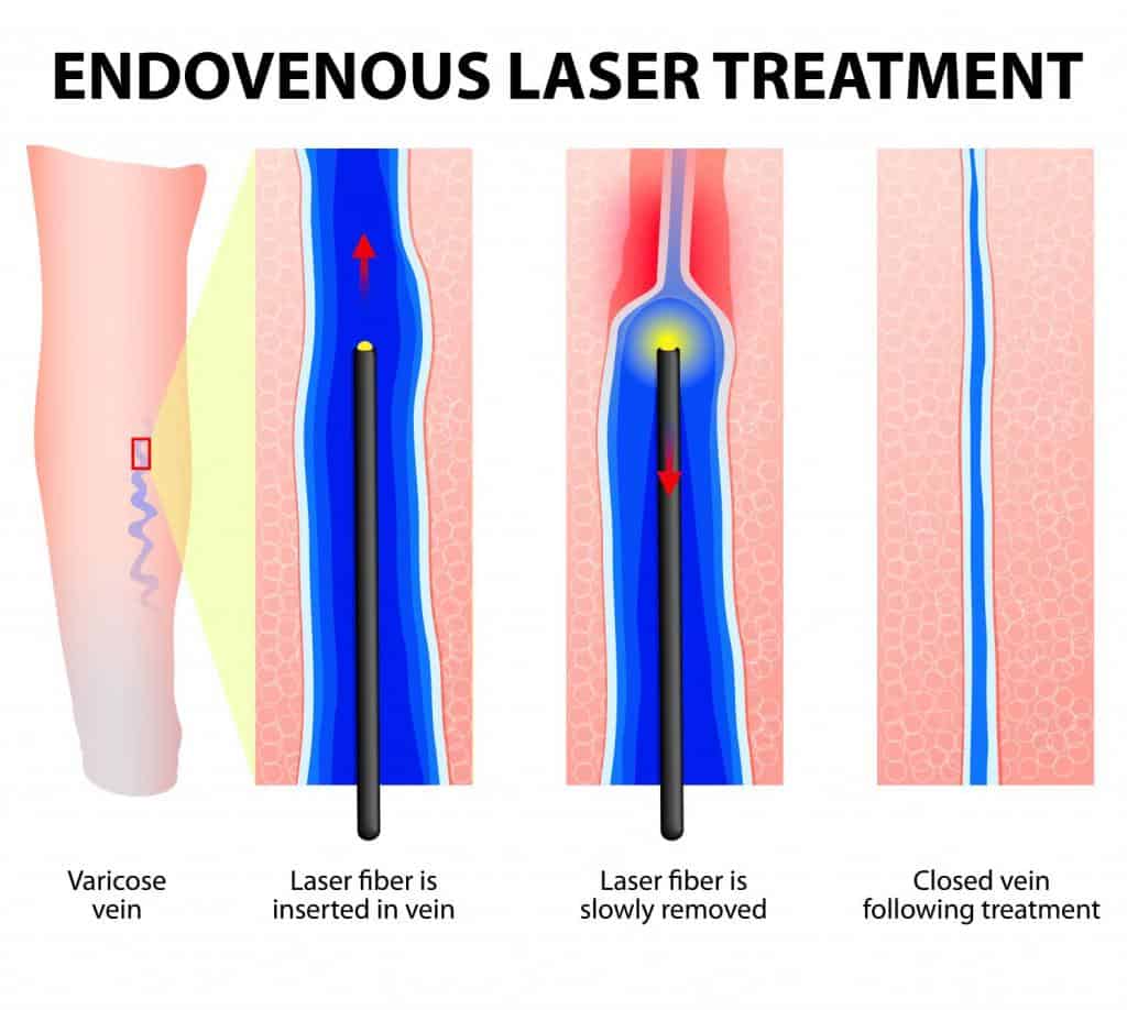 Blood Clot In Foot Symptoms Treatment BV Foot Clinic Blood Clot In Foot Symptoms Treatment BV Foot Clinic