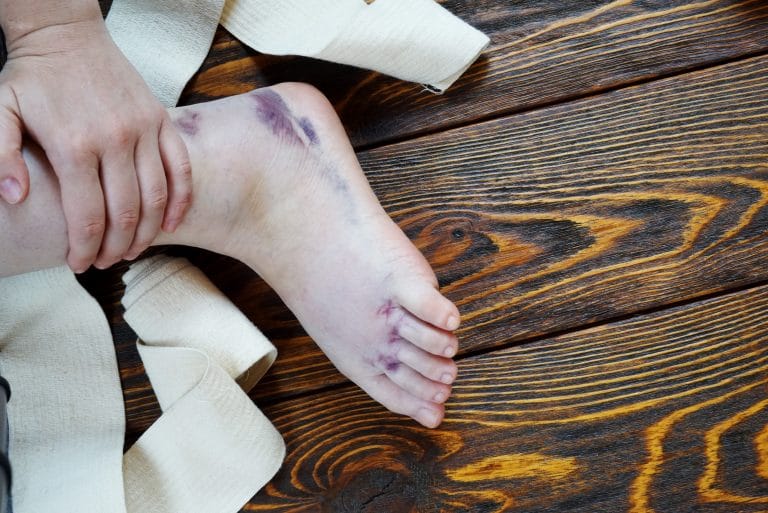 Broken Ankle - Beaver Valley Foot Clinic