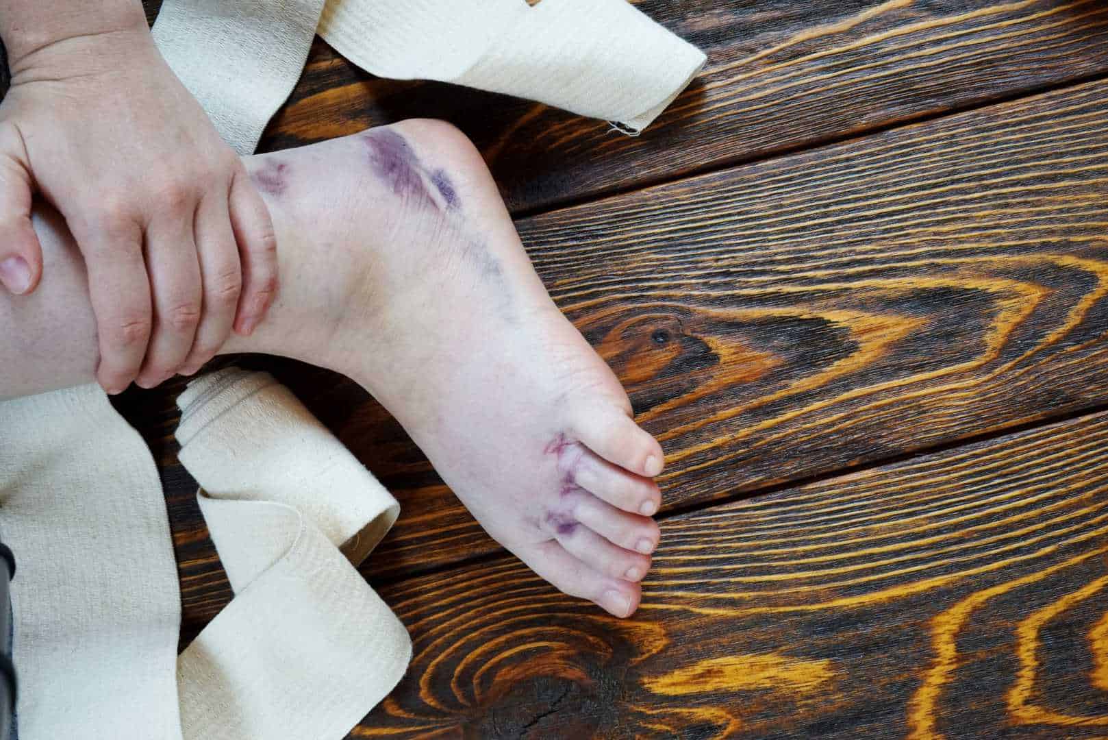Broken Ankle Beaver Valley Foot Clinic Broken Ankle Beaver Valley Foot Clinic